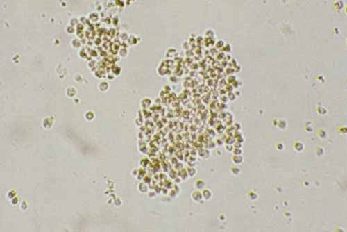 [Haematology] Microscopic Examination of Urinary Sediment - Cells ...