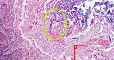 KIMAN - Making pathology simple!!: Mucormycosis - How to identify?