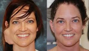 Medical Treatment Pictures-for Better Understanding: Superficial ...