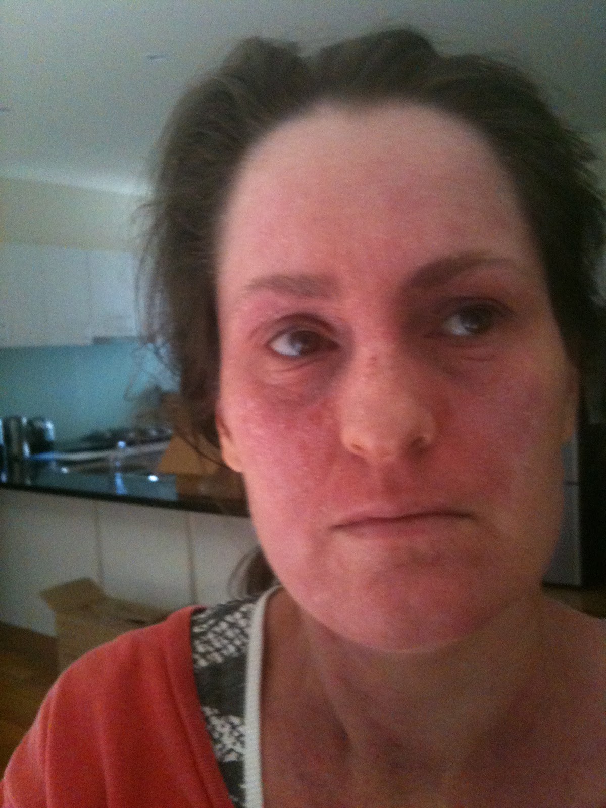 Topical Steroid Withdrawal Journey-Healing Eczema and Red Skin Syndrome ...