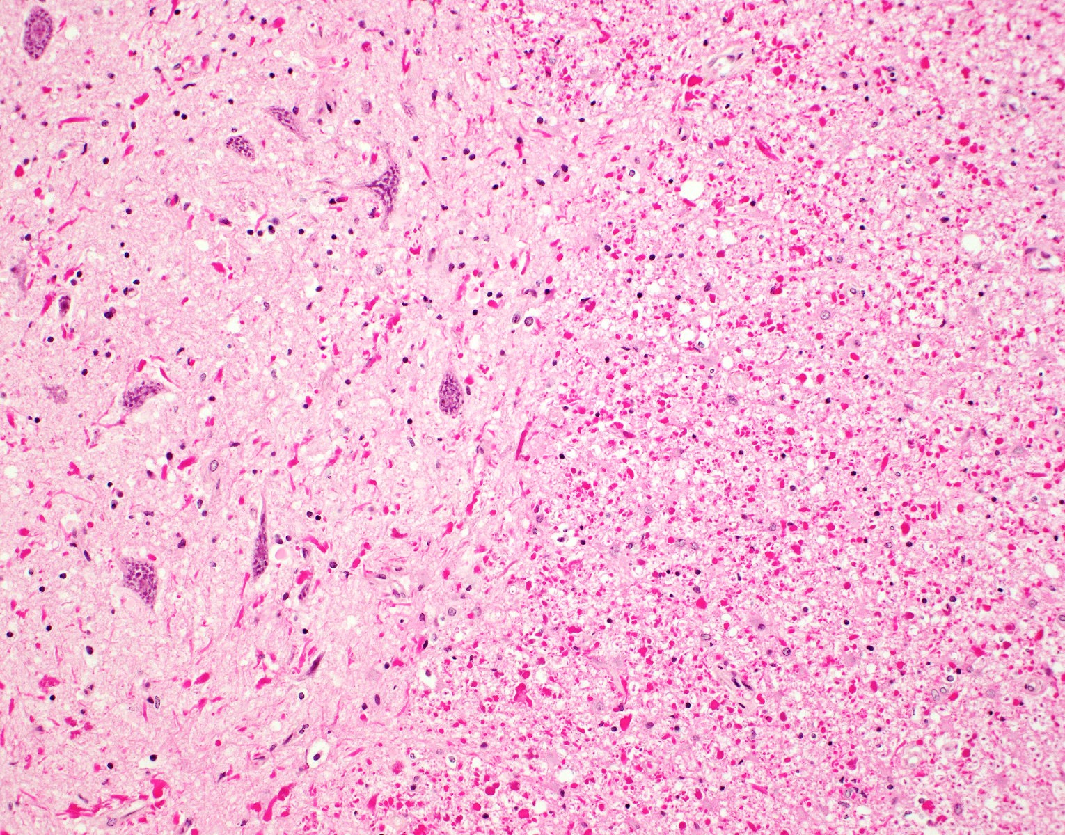 neuropathology blog: A case of Alexander disease