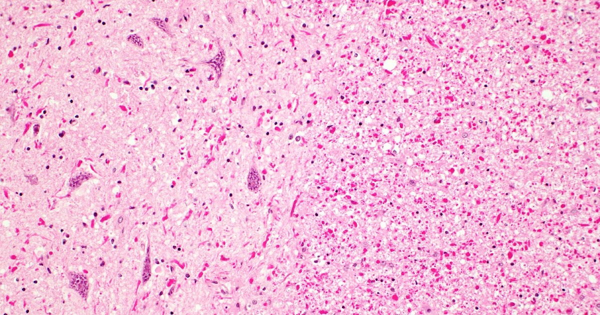 neuropathology blog: A case of Alexander disease