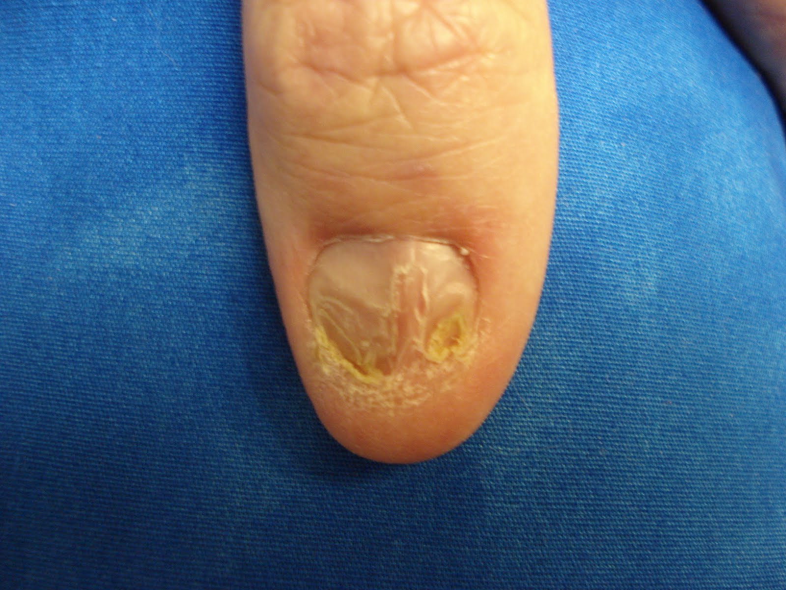 VIRTUAL GRAND ROUNDS IN DERMATOLOGY 2.0: Two Patients with Longitudinal ...