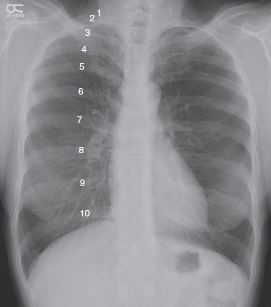 Rozpoznawanie technicznie dobrego zdjęcia klatki piersiowej