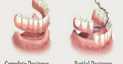 wisdom tooth extraction : Complete Dentures
