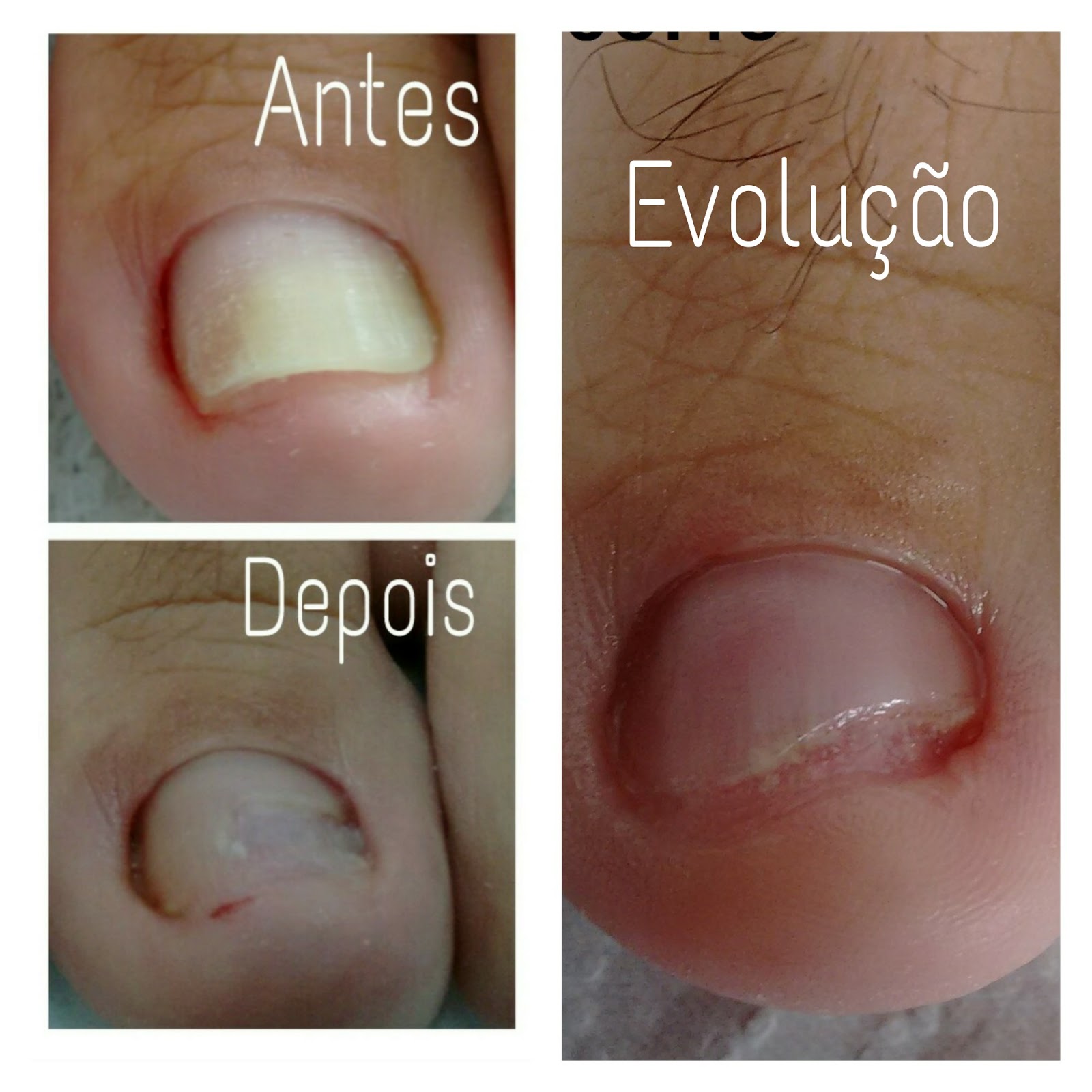 Podologia & Esmalteria Lilian Gomes: Tratamento Onicomicose