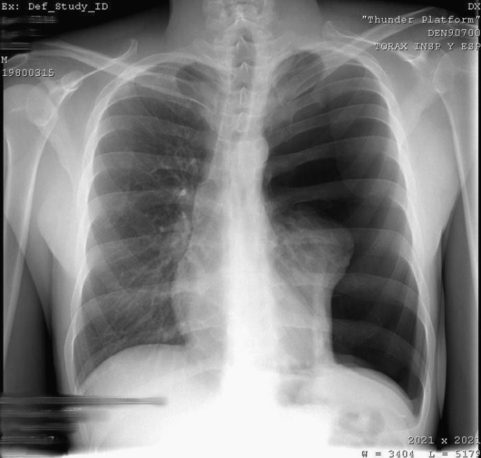 Examen del Torax y Pulmon. ~ Dr.Martinez Bonilla