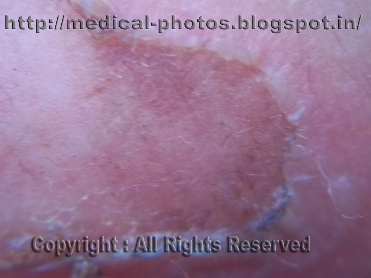 MEDICAL PHOTOGRAPHY AND VIDEOS, MEDICAL PHOTOGRAPHY: COMMON SKIN BURN ...