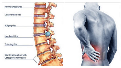 Chronic Back Pain You Need to Know