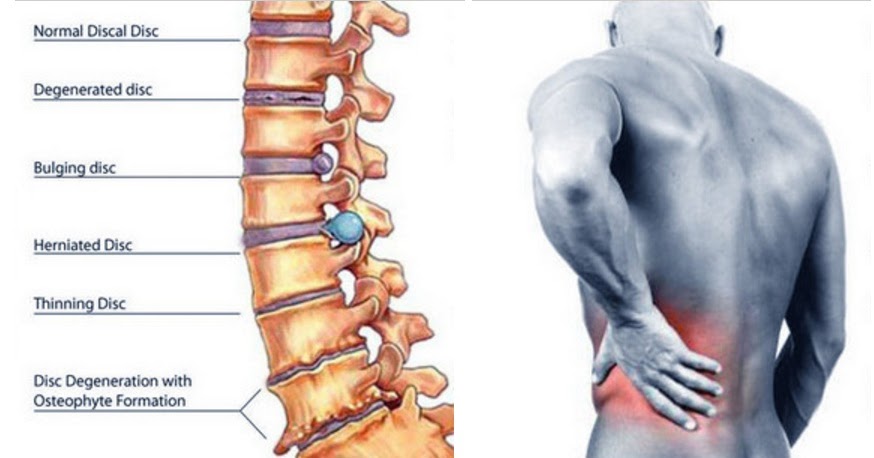Chronic Back Pain You Need to Know