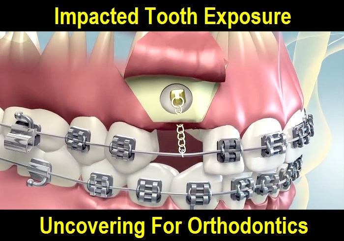 IMPACTED TOOTH Exposure & Uncovering For Orthodontics - Odonto-Tv