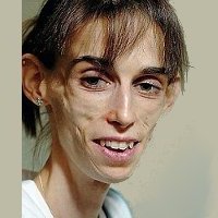 Anorexia Victims Finally Worst that Could Not Survive | Health 174