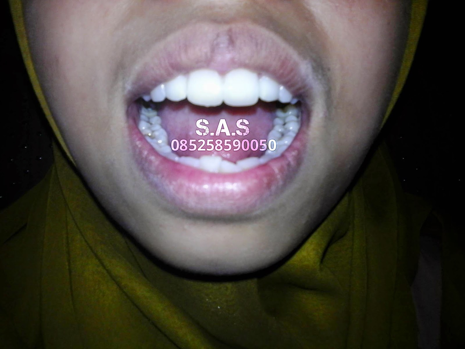 Merapikan Gigi Renggang (Diastema) dan Gigi Tidak Rata Secara Instan ...