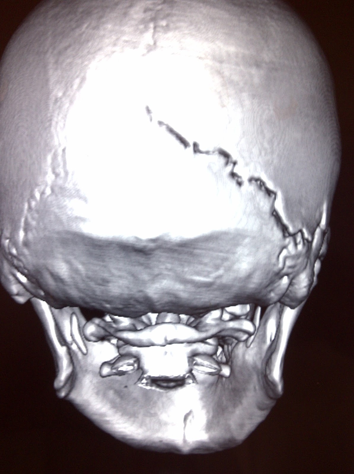 RUANG PRAKTEK BEDAH - DOKTER RAMZI SPB (K) V: Gambaran patah tulang ...