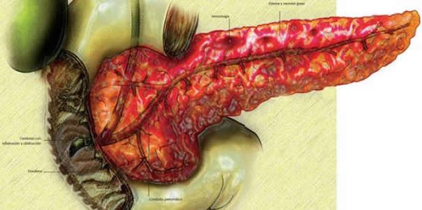 Pankreatitis (Radang Pankreas) | Tongkat Aesculapius