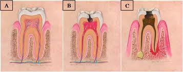 Gigiku Sehat Gigiku Kuat: Penyakit Jaringan Keras dan Jaringan Lunak Gigi