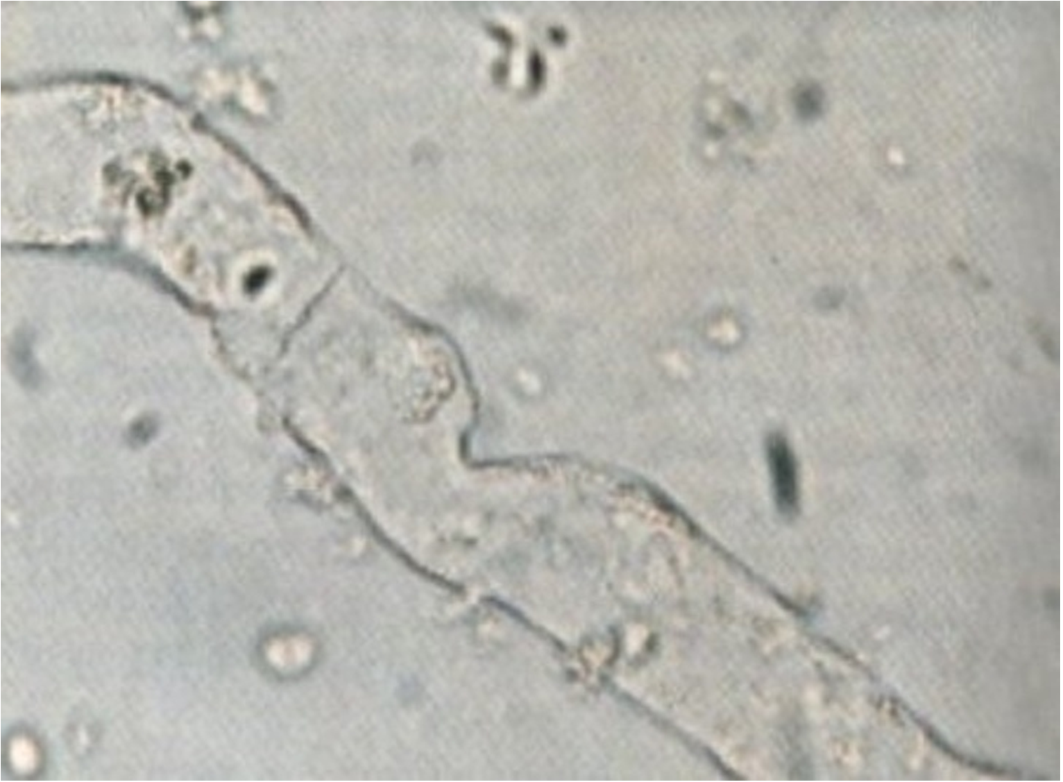 Cilindro Hialino Na Urina - RETOEDU