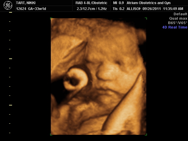 Nikki, David, William, Elliott, and Layla: 33 Weeks - 3D ultrasound
