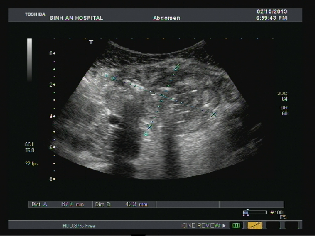 VIETNAMESE MEDIC ULTRASOUND: CASE 212: APPENDICEAL ABSCESS, Dr NGUYỄN ...