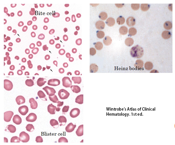 Intan Risna's: G6PD Deficiency