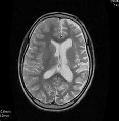 Ultimate Radiology : Rasmussen Encephalitis