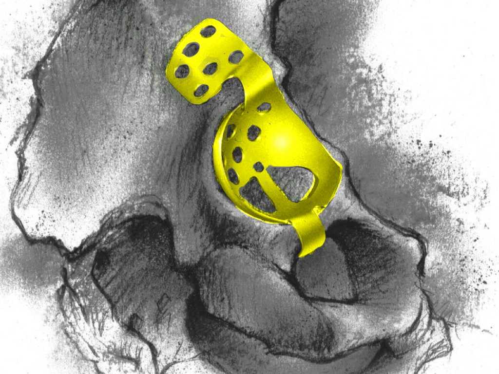 OSSA CARPALIA ©: ARTROPLASTÍA TOTAL DE CADERA DERECHA PRIMARIA Y ...