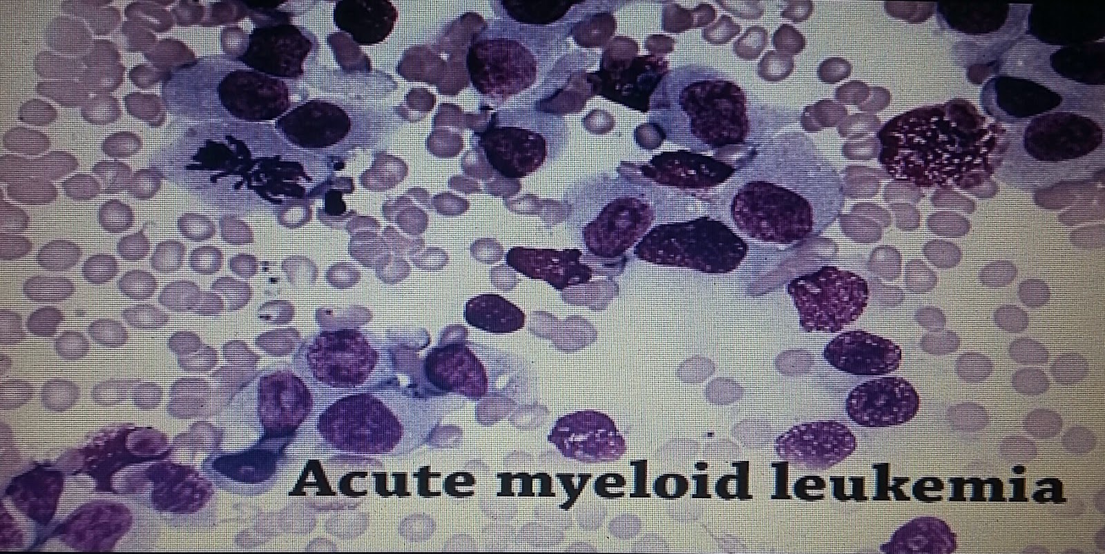 ogasa10.blogspot.com: FAKTOR ATAU PENYEBAB LEUKEMIA AKUT