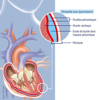 Pericardite - Sinais, Sintomas e Diagnóstico - As Doenças Cardíacas