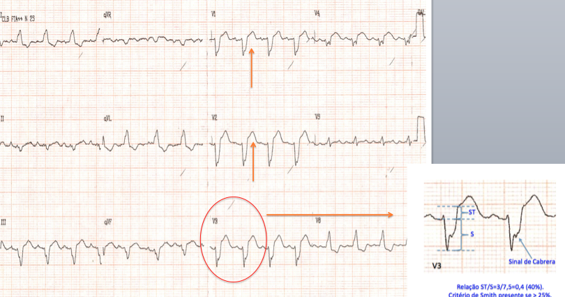 Blog de Eletrocardiografia: ATUALIZAÇÃO: CRITÉRIOS PARA DIAGNOSTICAR ...