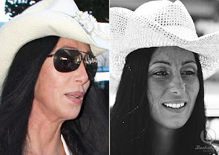 Cher Plastic Surgery