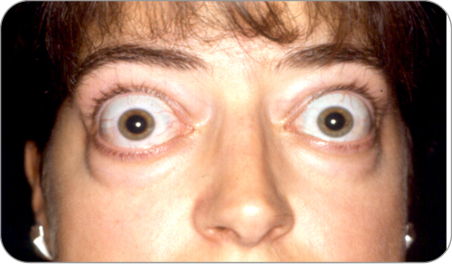 Clínica de Ojos Oftalmic Láser: Exfotalmos o Proptosis