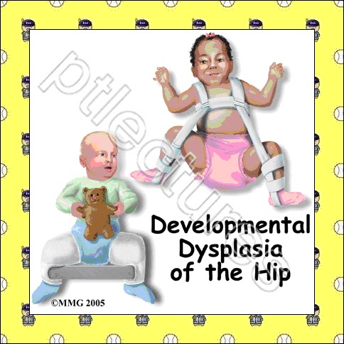 Congenital hip dislocation | Advance for Physical Therapy and Rehab ...
