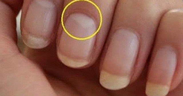 Symbol of Nails Double Colored Liver Diseases