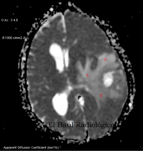El Baúl Radiológico: 1) EDEMA VASOGÉNICO EN EL SISTEMA NERVIOSO CENTRAL ...