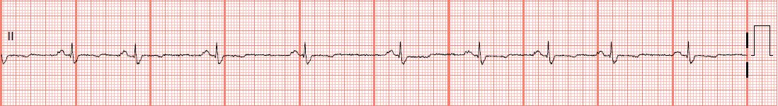 EKG Rhythm Strip Quiz 51: Sinus Rhythms