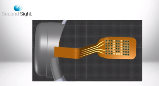 FDA Approves Argus II - First Bionic Eye | THE OFFICIAL ANDREASCY ...
