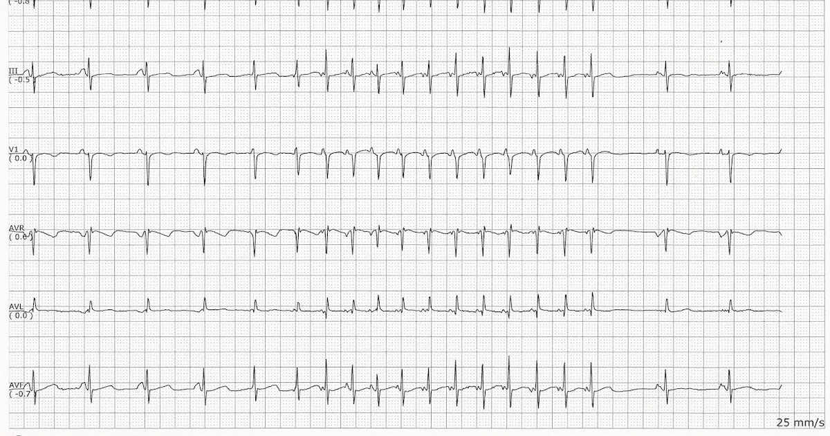 Float Nurse: Sinus Rhythm with Runs of Paroxysmal Atrial Tachycardia