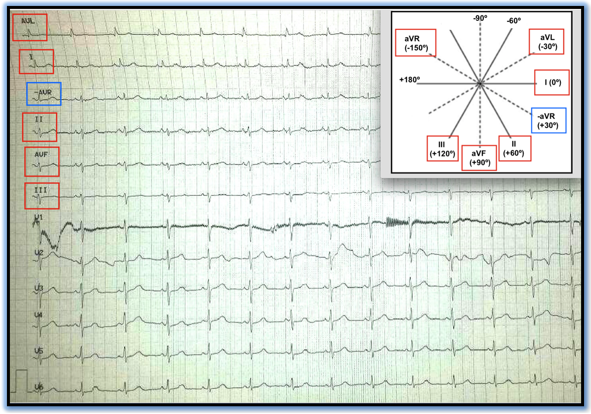 ECG Interpretation: ECG Blog #114 (Standard Recording — Cabrera Format ...
