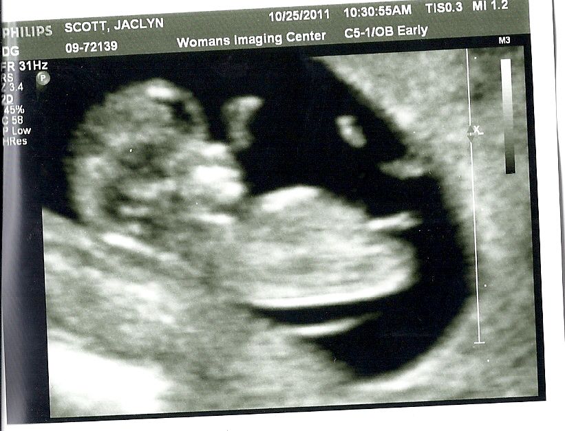 Our Scott Spot: 11 Week Ultrasound