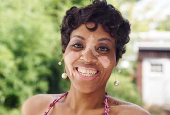 Photo: Woman with rare skin condition says men find it irresistible