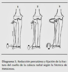 Fracturas de la extremidad proximal del radio - II | Todo sobre ...