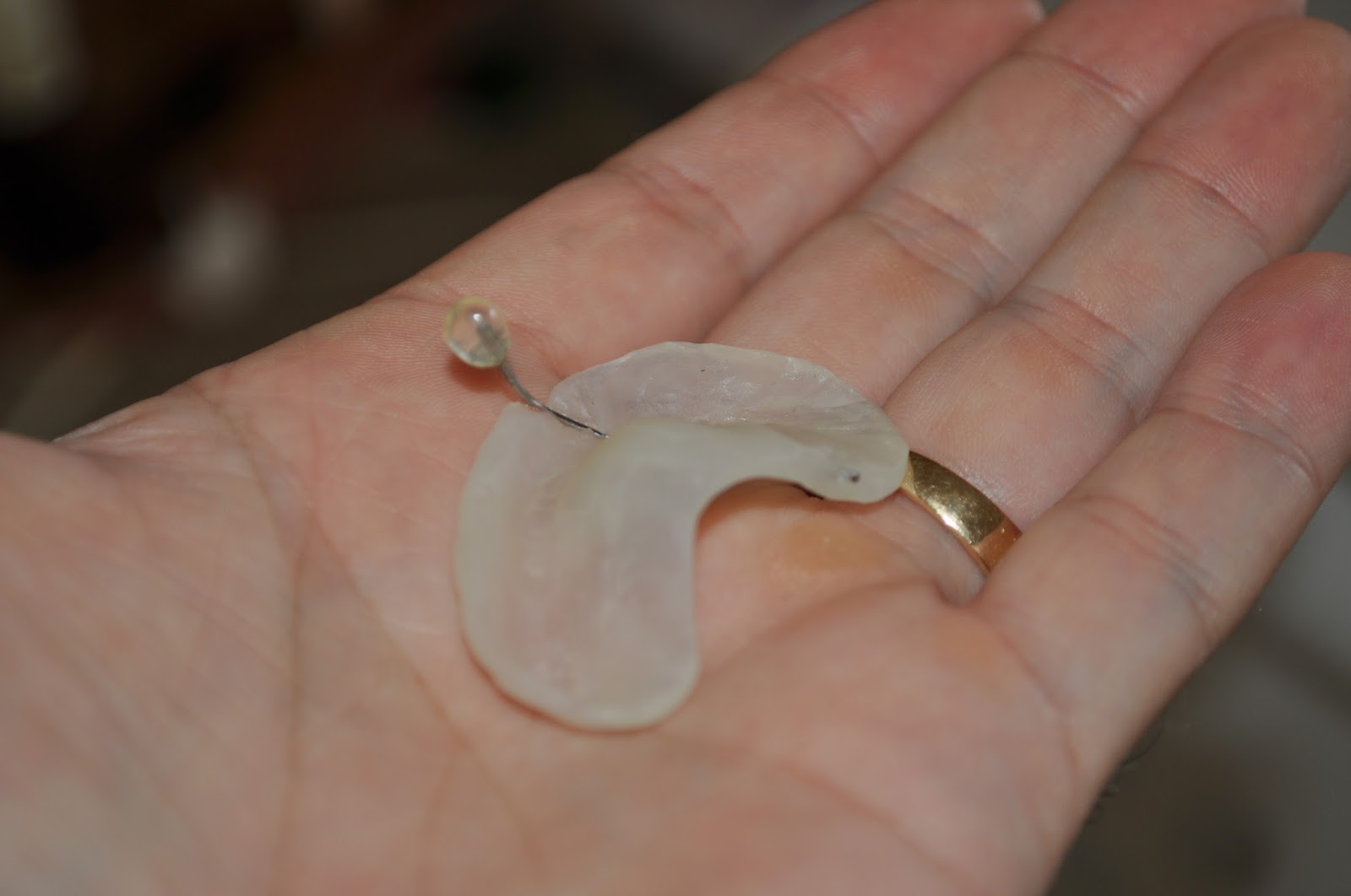 Our Cleft Story: NAM (Nasoalveolar Molding) & Taping