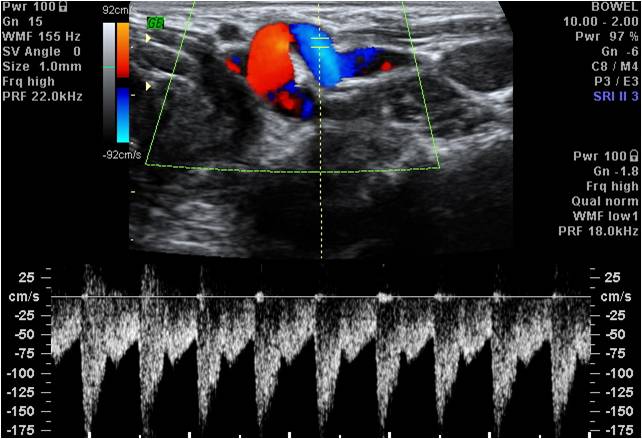 Abnormally curved and tortuous internal carotid artery : USG & Doppler ...