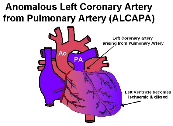Michaela's Broken Heart Our ALCAPA Warrior: What is ALCAPA?