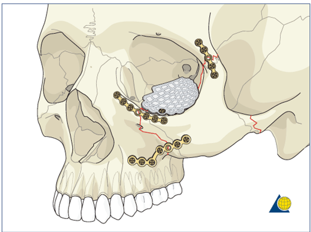 Fraturas do Complexo Zigomático ~ FUTURO CIRURGIÃO BUCOMAXILO FACIAL