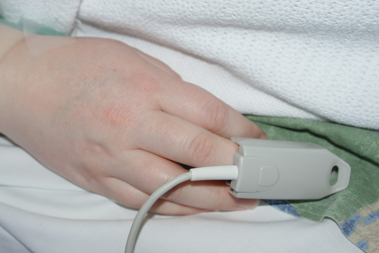 Braces + SARPE/SARME Surgery: SARPE/SARME Surgery