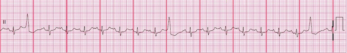 EKG Rhythm Strip Quiz 18