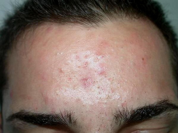 Acne Comedonica – Causes and Treatment of Comedonal Acne [Exposed Skin ...