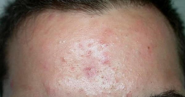 Acne Comedonica – Causes and Treatment of Comedonal Acne [Exposed Skin ...