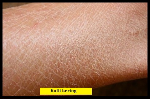 Cara Mengatasi Kulit Kering Bersisik Dan Gatal Dengan Mudah | DAUN LEBAT